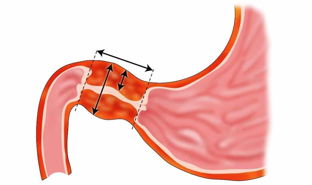 Hẹp Môn Vị Bài Giảng CĐha