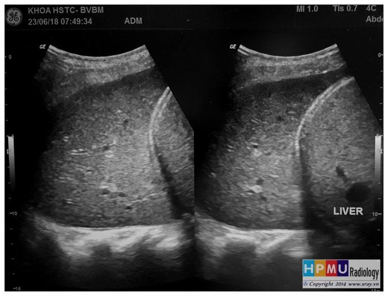 Xẹp Phổi | Bài giảng CĐHA