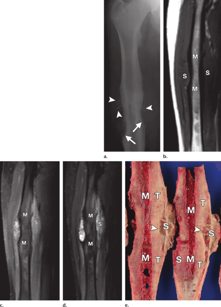 Sarcoma Ewing | Bài giảng CĐHA