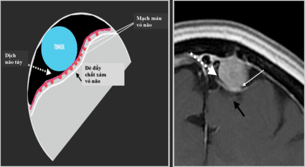 Tiếp Cận Chẩn Đoán U Não | Bài giảng CĐHA