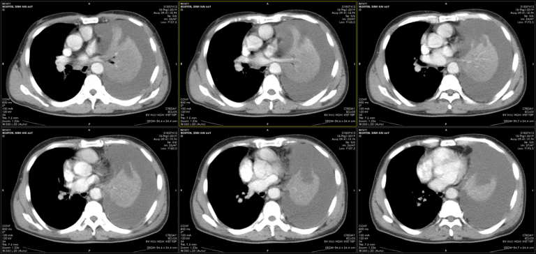 Xẹp Phổi | Bài giảng CĐHA